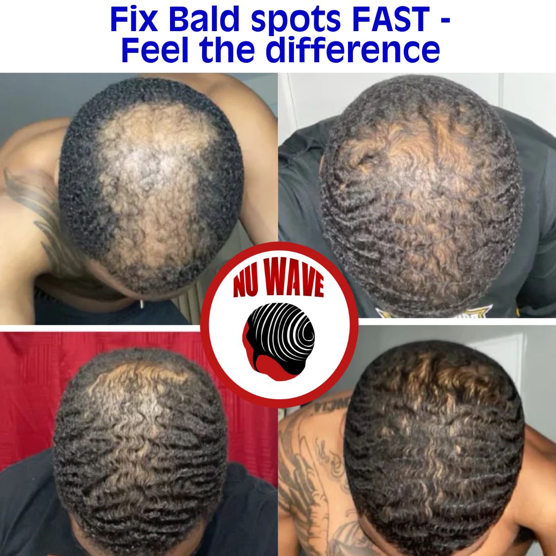 Why Men Over 30 Start Losing Hair and How to Reverse It Naturally ...